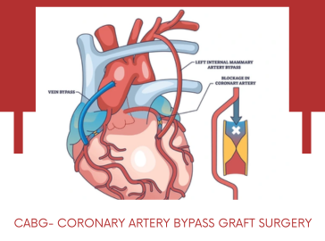 Coronary Artery Bypass Graft Surgery(CABG) in Pune
